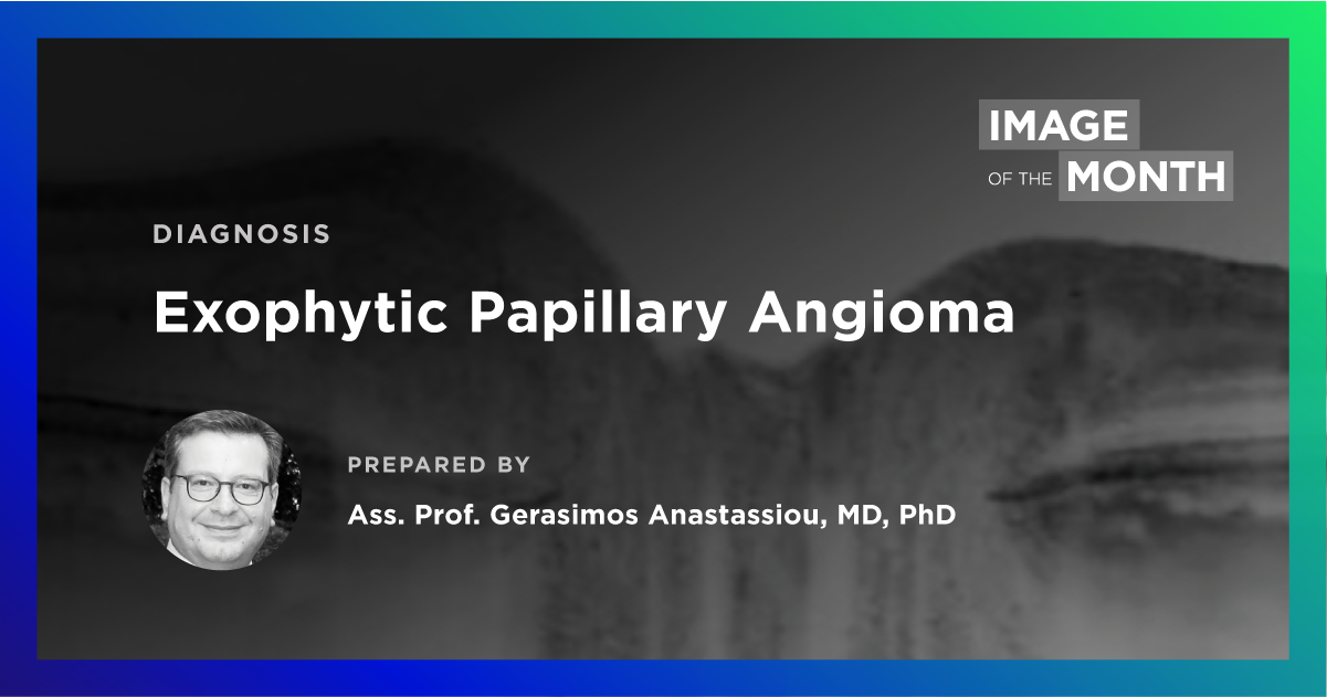 Image of the Month: Exophytic Papillary Angioma