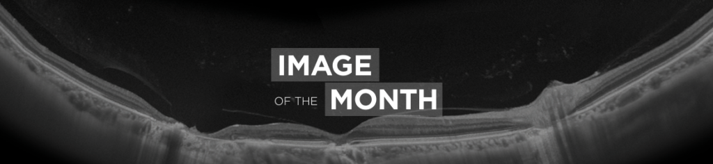 IOTM: Choroidal Nevus with Drusen