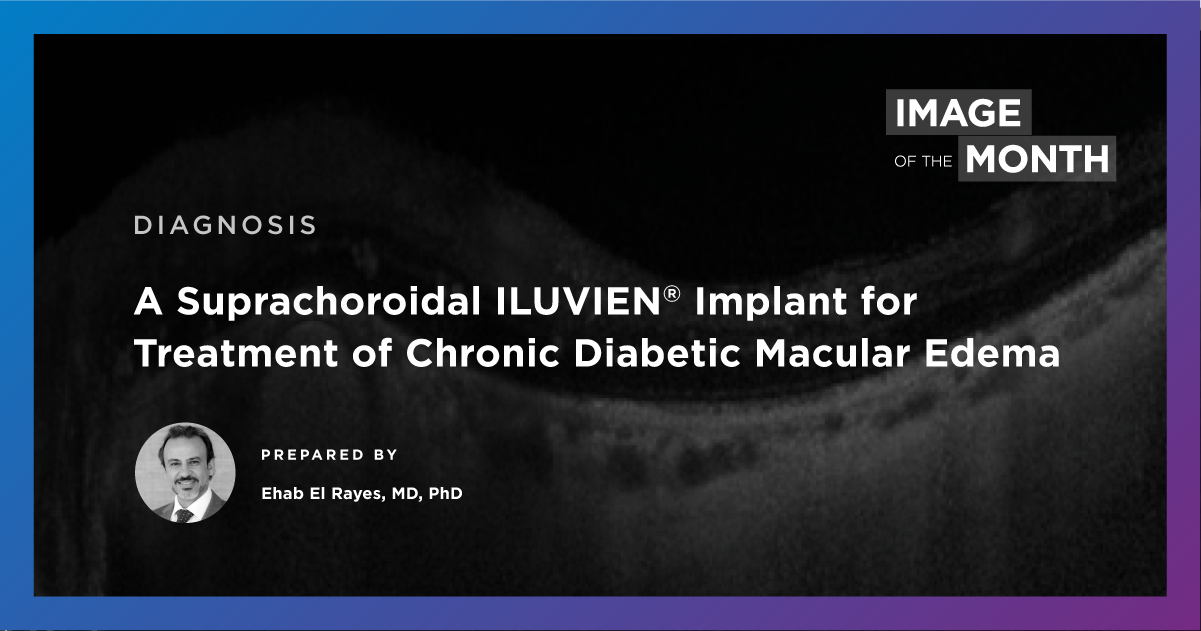 Suprachoroidal ILUVIEN® Implant for Treatment of Diabetic Macular Edema