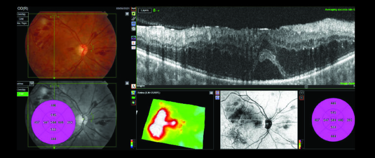 Advanced PDR with Non-Perfusion & Macular Edema Case Study