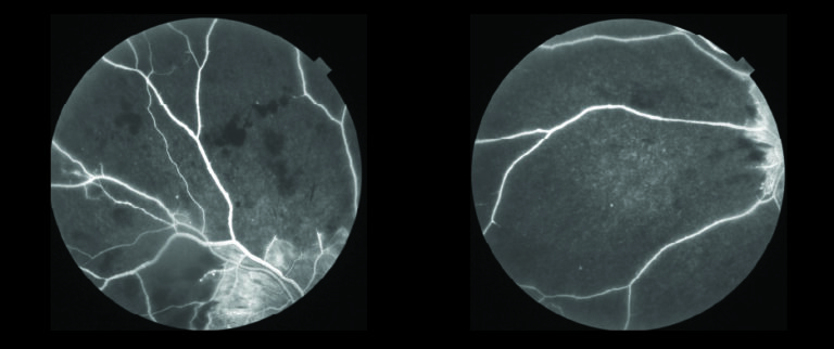Advanced PDR with Non-Perfusion & Macular Edema Case Study