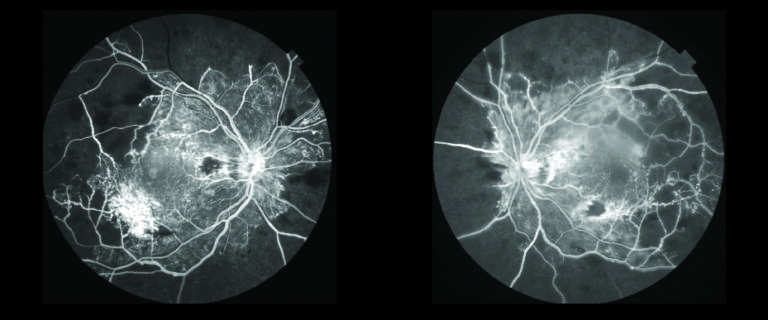 Advanced PDR with Non-Perfusion & Macular Edema Case Study