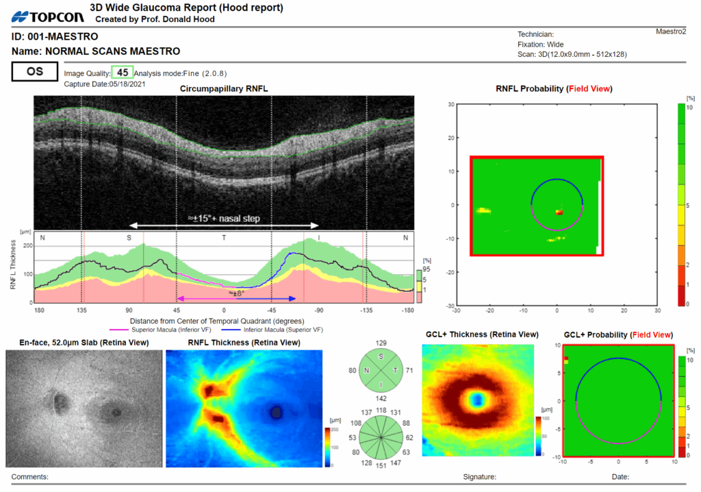 Maestro2 OCT Fundus Camera and the Hood Report for Glaucoma: Advanced ...